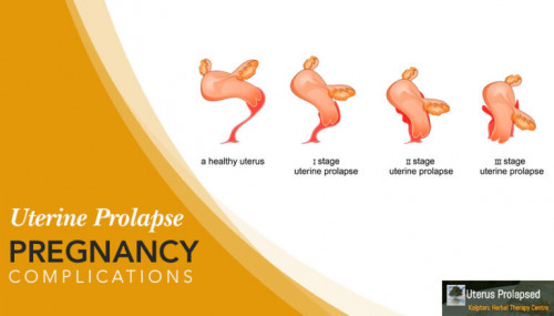 Uterine Prolapse Pregnancy Complications Yu